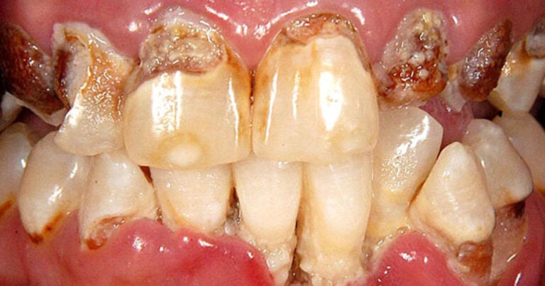 Meth Mouth: What It Looks Like and How to Treat It
