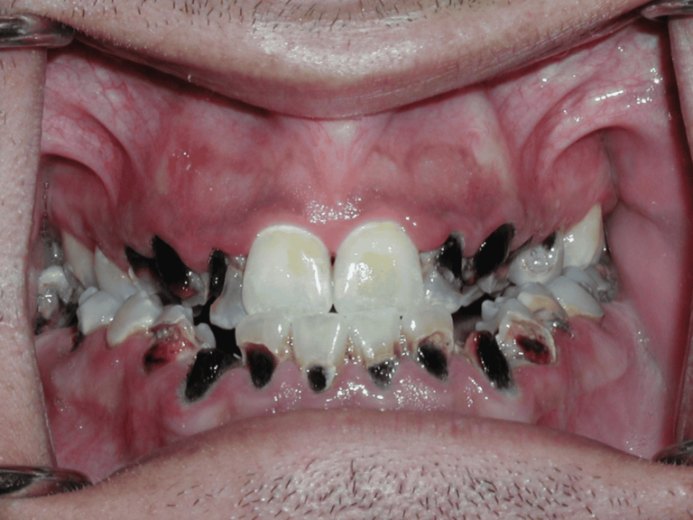 Meth Mouth: What It Looks Like and How to Treat It